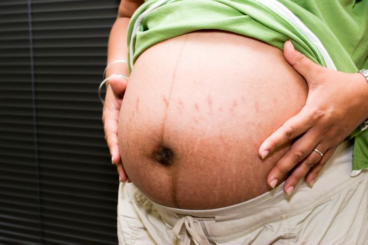 4 Fakta di Balik Linea Nigra, Garis Hitam yang di Perut Para Ibu Hamil ...